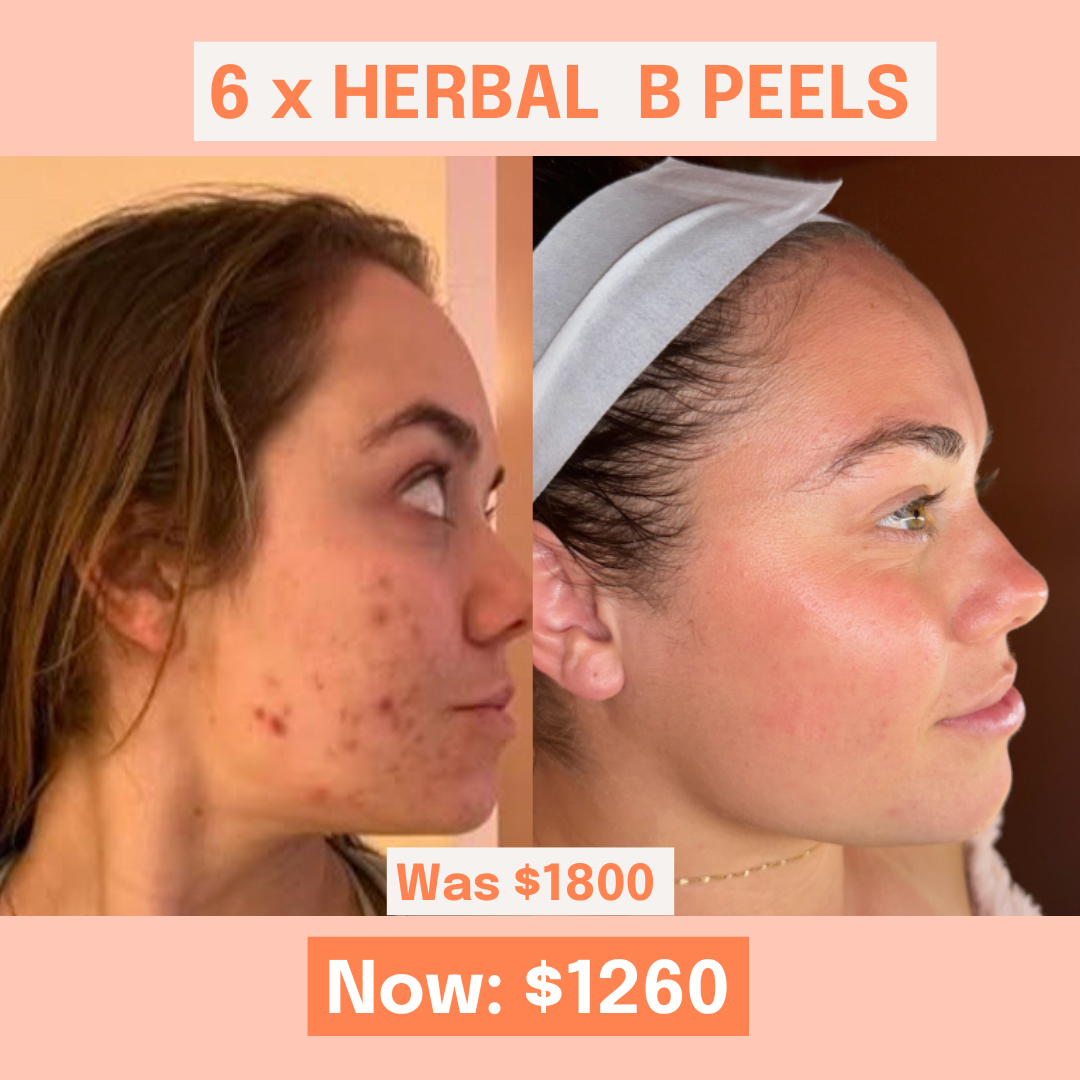 6 x Herbal B Peel Pack – Fayshell