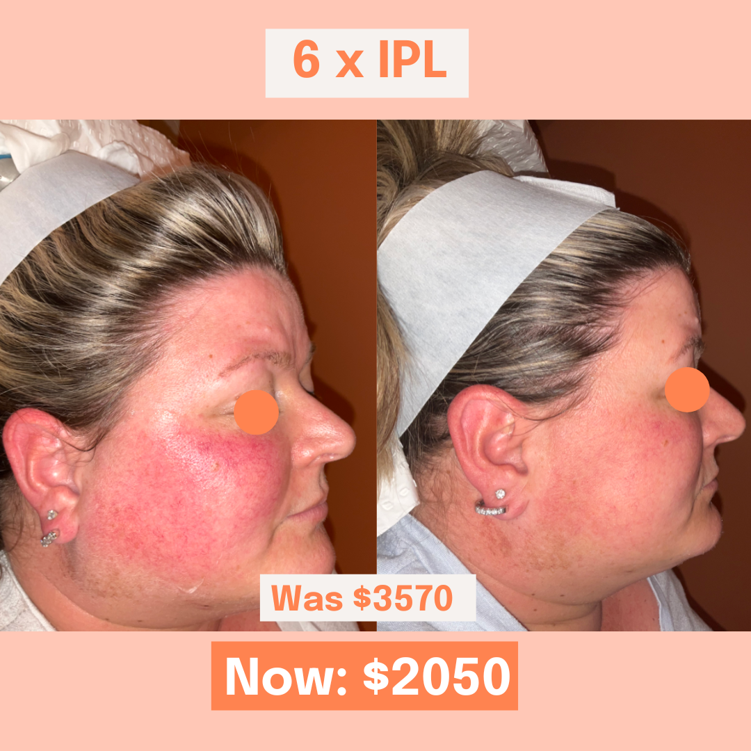 6 x IPL Treatments – Fayshell