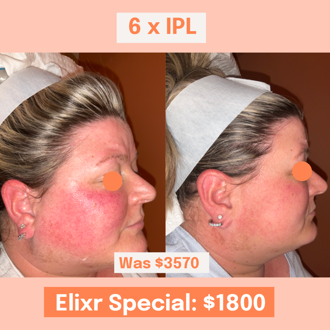6 x IPL Treatments – Fayshell